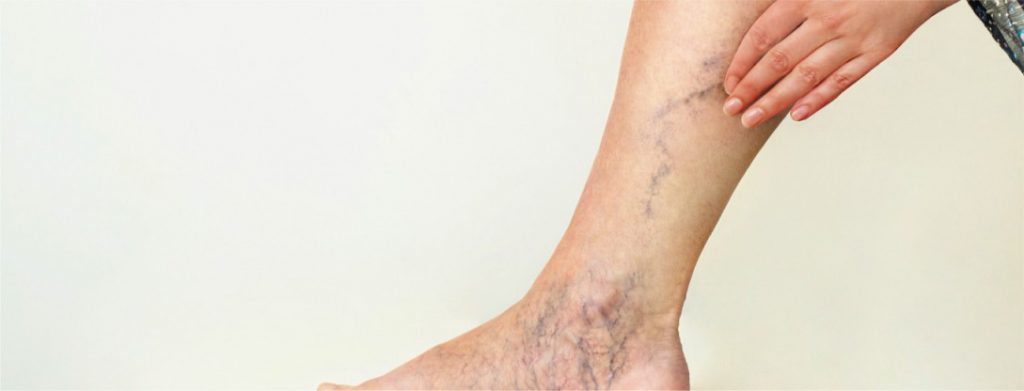 Varizes - Dr. Francisco Coral